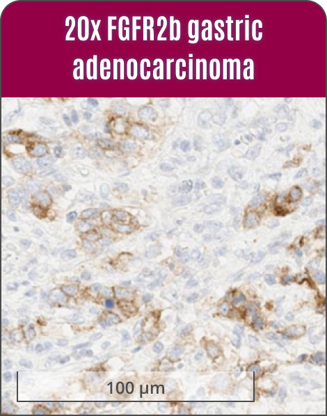 IHC Interpretation | FGFR2b.com