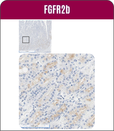 IHC Interpretation | FGFR2b.com