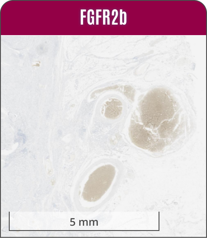 IHC Interpretation | FGFR2b.com