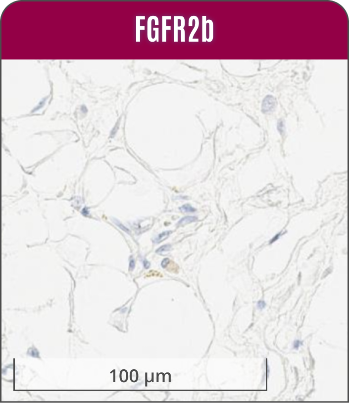 IHC Interpretation | FGFR2b.com